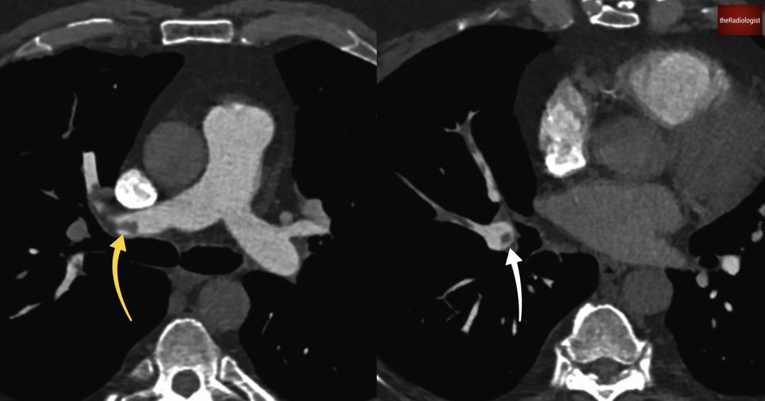 Pulmonary embolism - the Radiologist