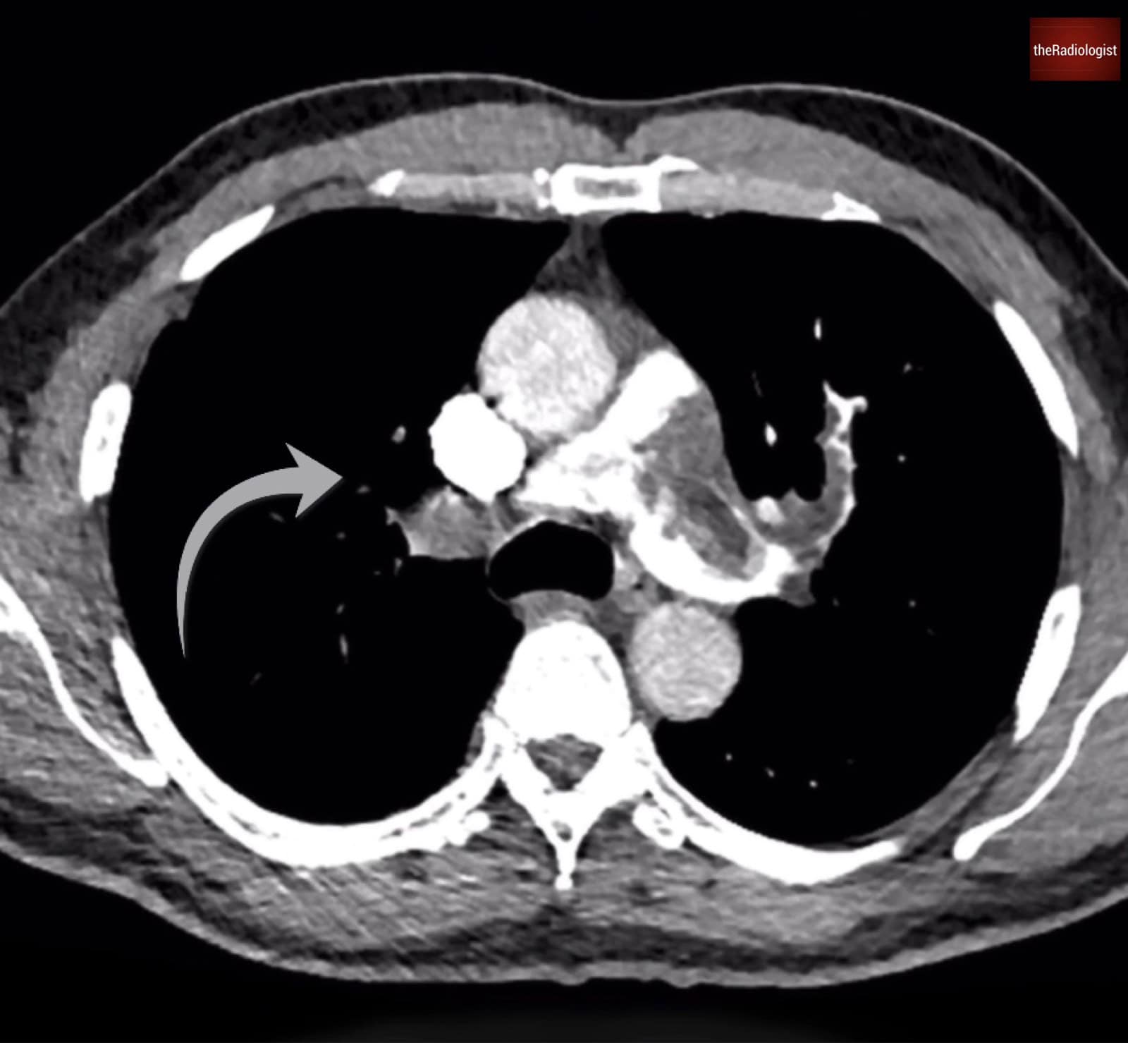 Pulmonary embolism - the Radiologist