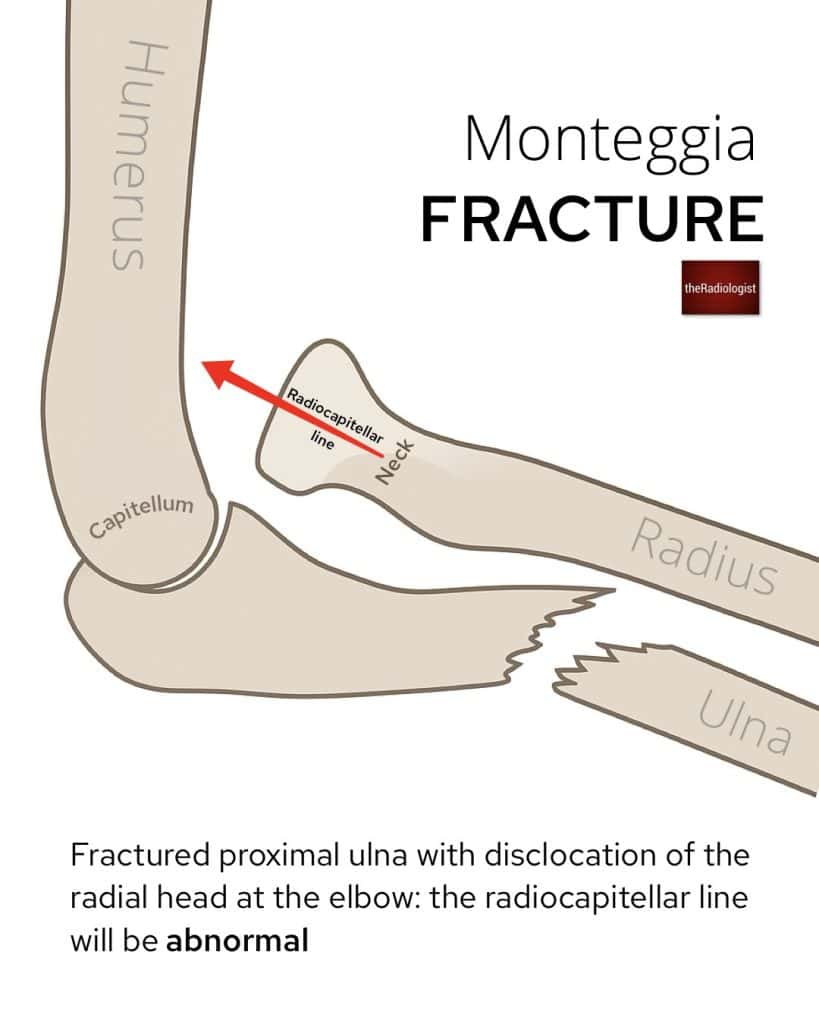 Elbow X-Ray Essentials – the Radiologist