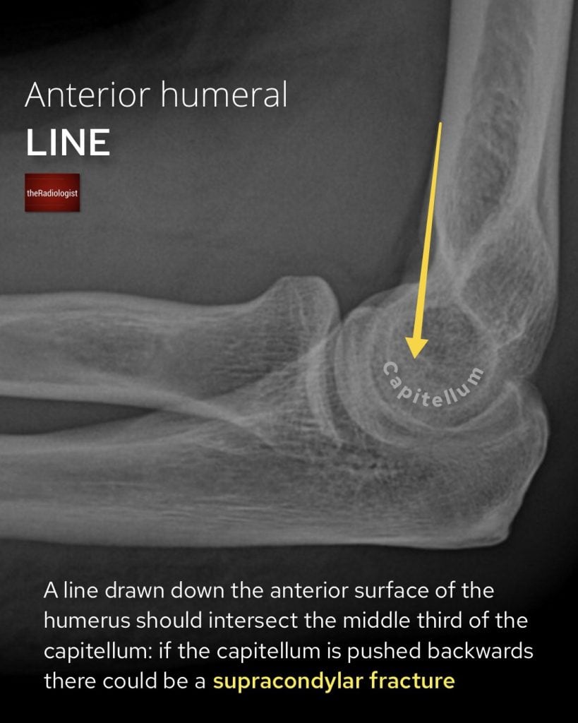 Elbow X-Ray Essentials – the Radiologist