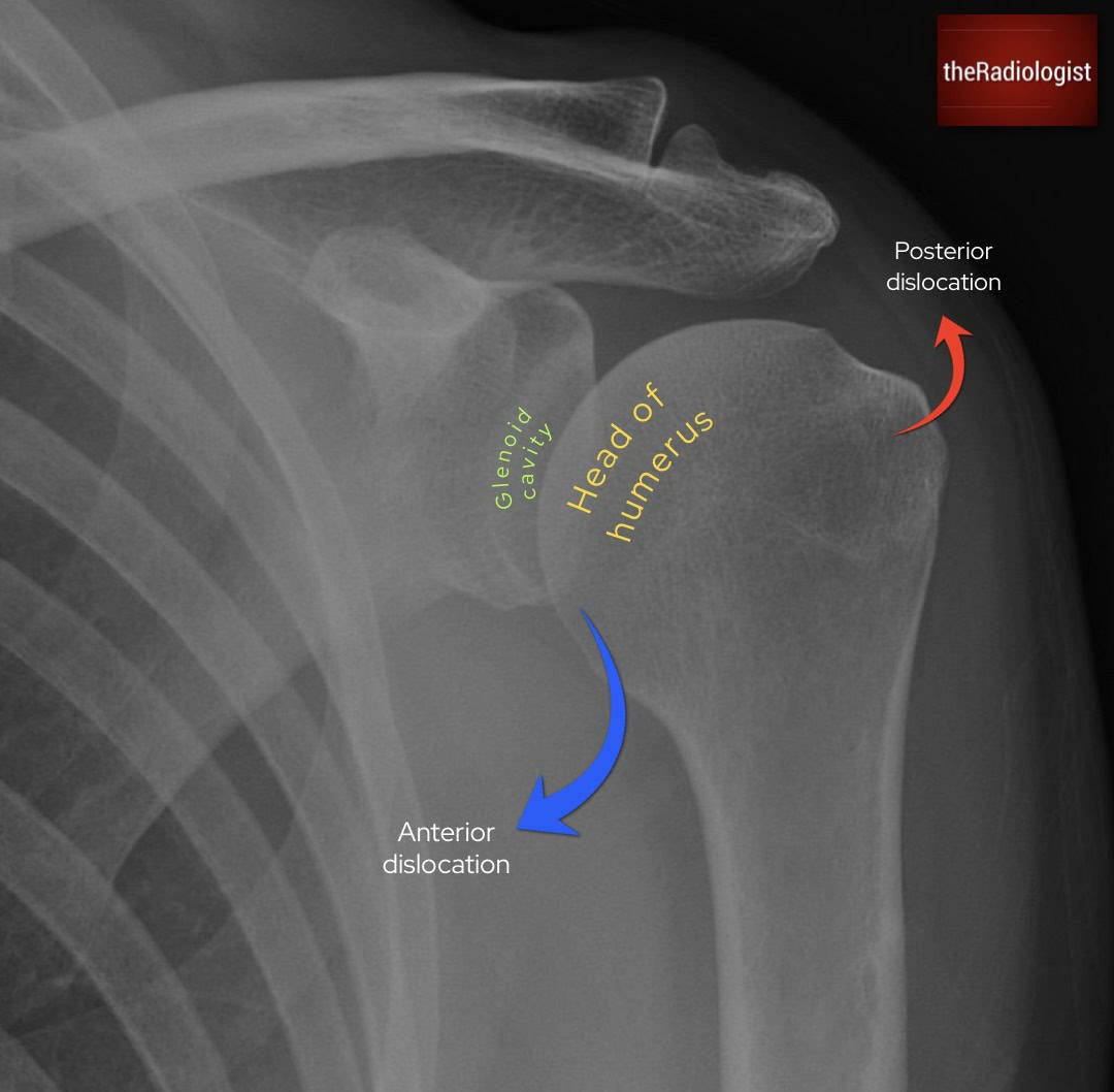 Shoulder X-Ray Essentials – the Radiologist