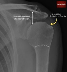 Shoulder X-Ray Essentials – the Radiologist
