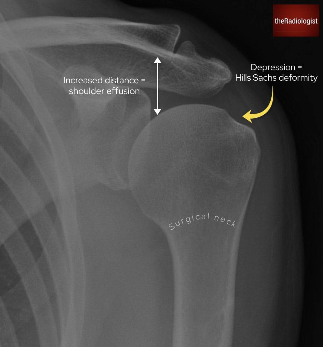 Shoulder X-Ray Essentials – the Radiologist