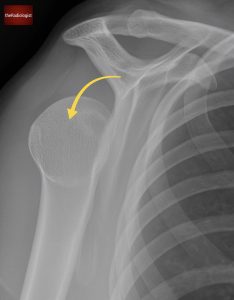 How to Read a Shoulder X-Ray | Anatomy and Views Guide