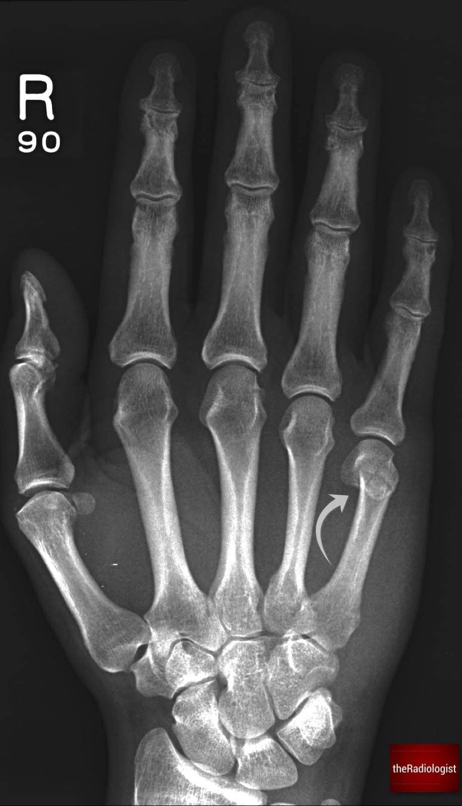 Hand and Wrist X-Ray Guide – the Radiologist