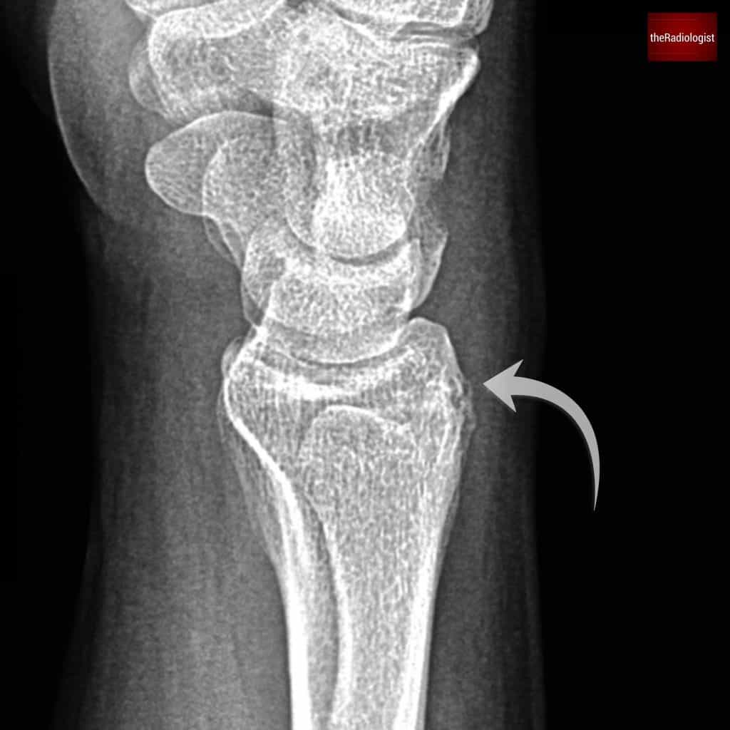 Hand and Wrist X-Ray Guide – the Radiologist