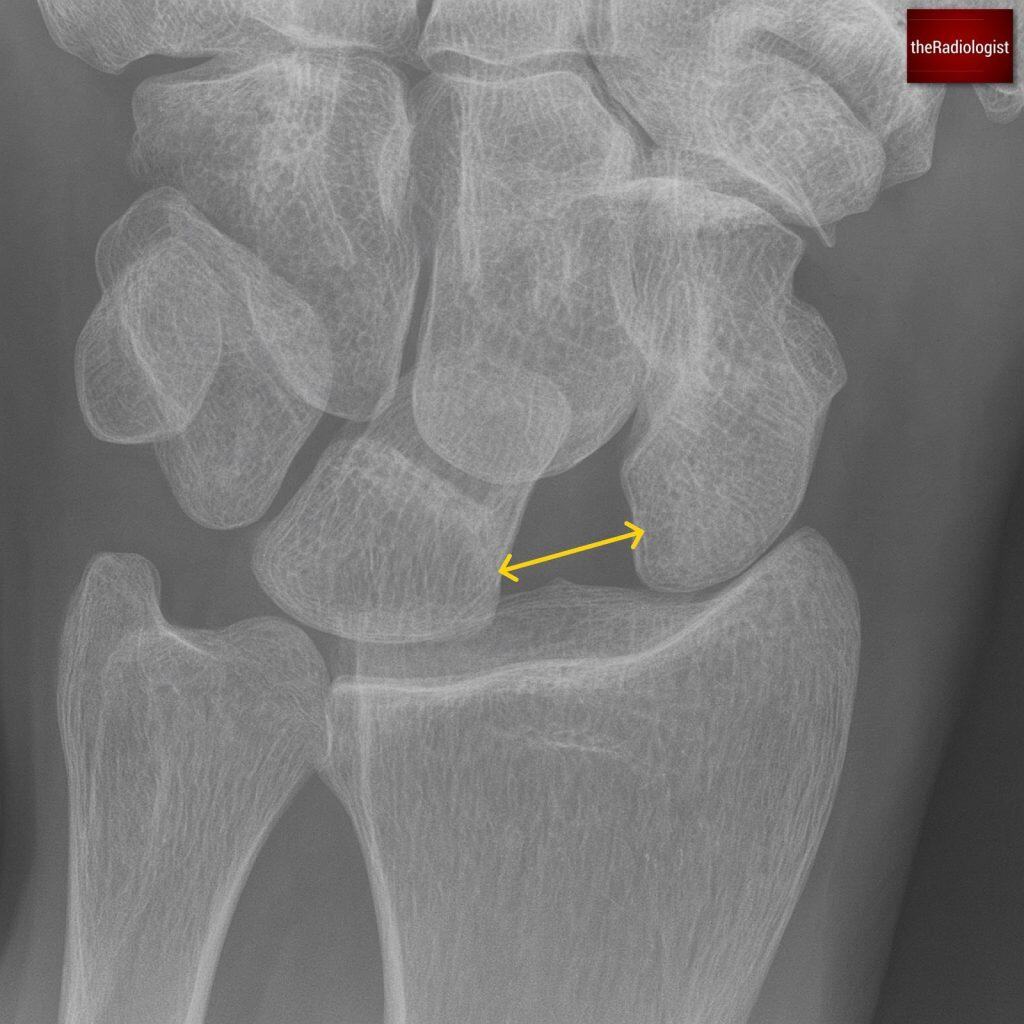 Hand and Wrist X-Ray Guide – the Radiologist
