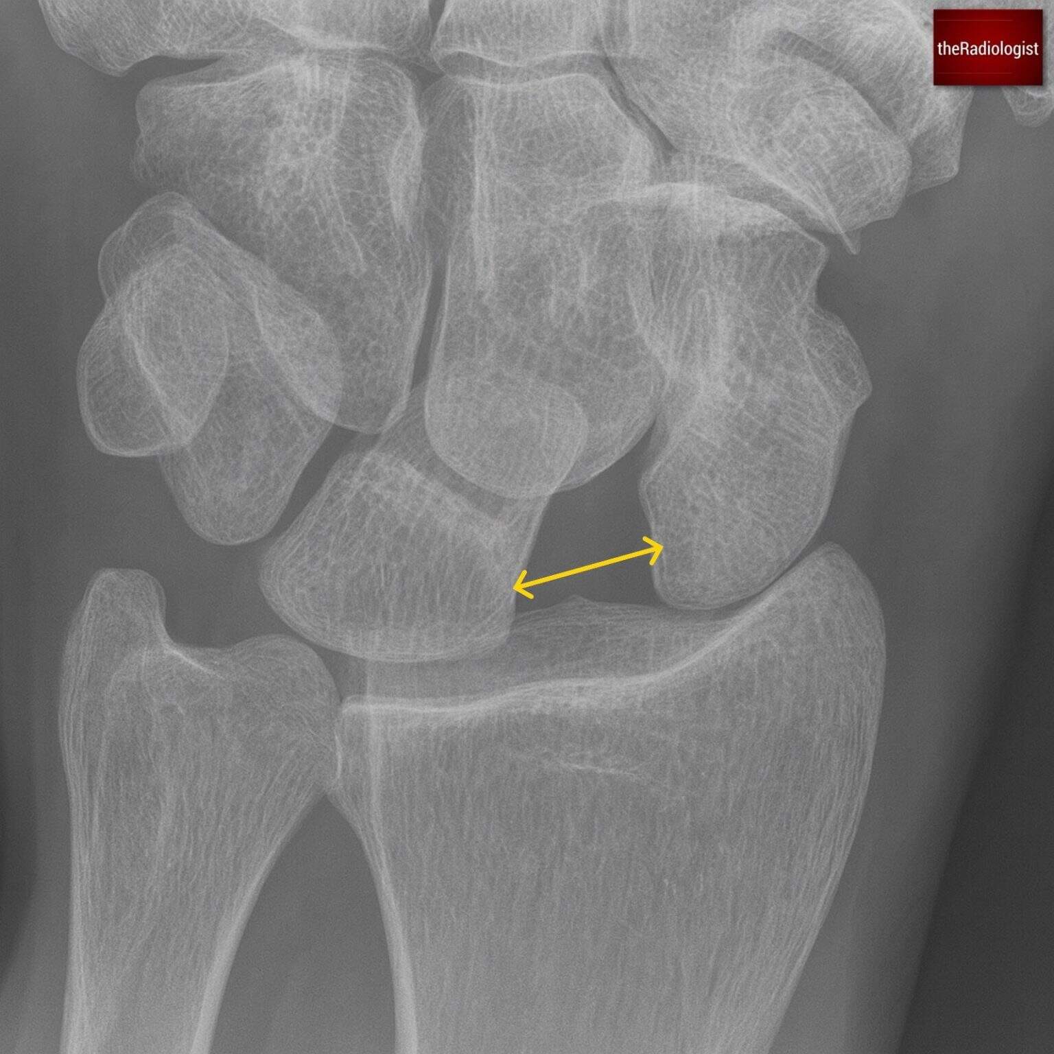 Hand and Wrist X-Ray Guide – the Radiologist