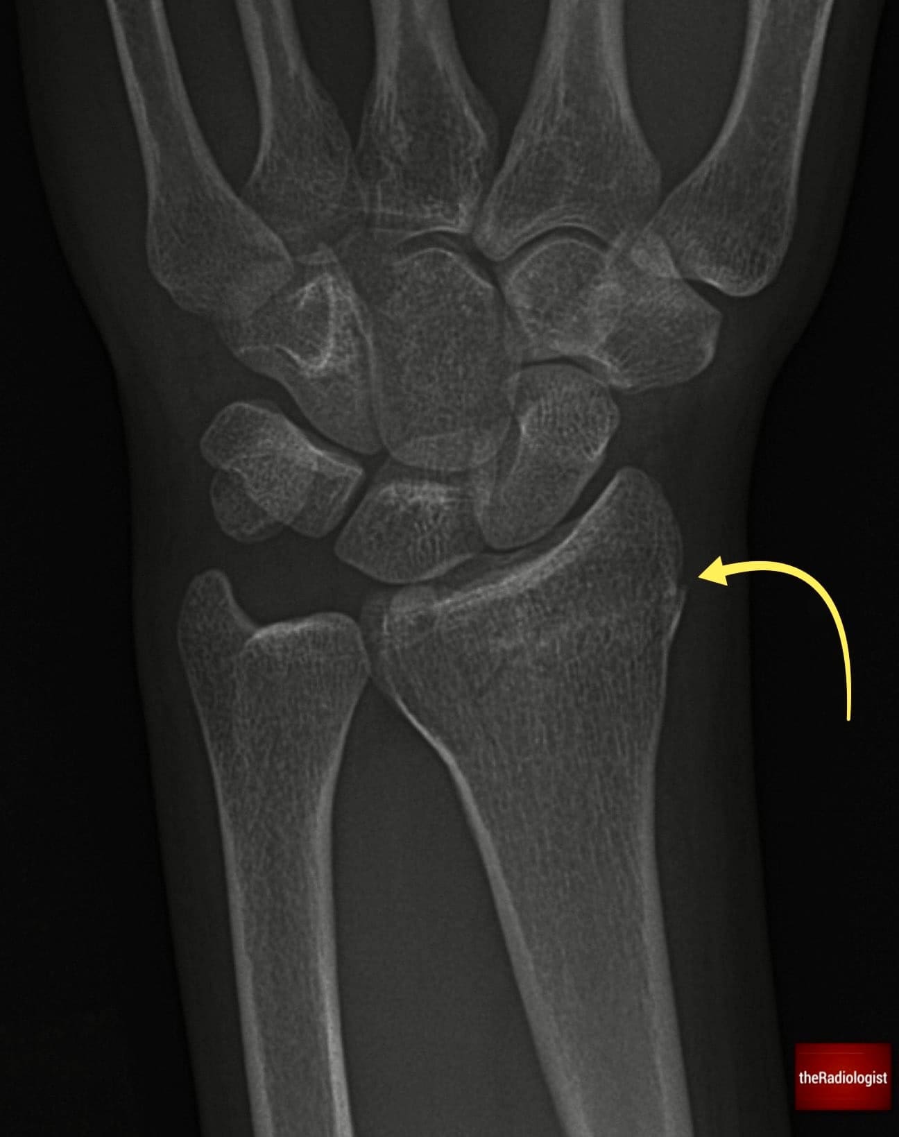 Hand and Wrist X-Ray Guide – the Radiologist