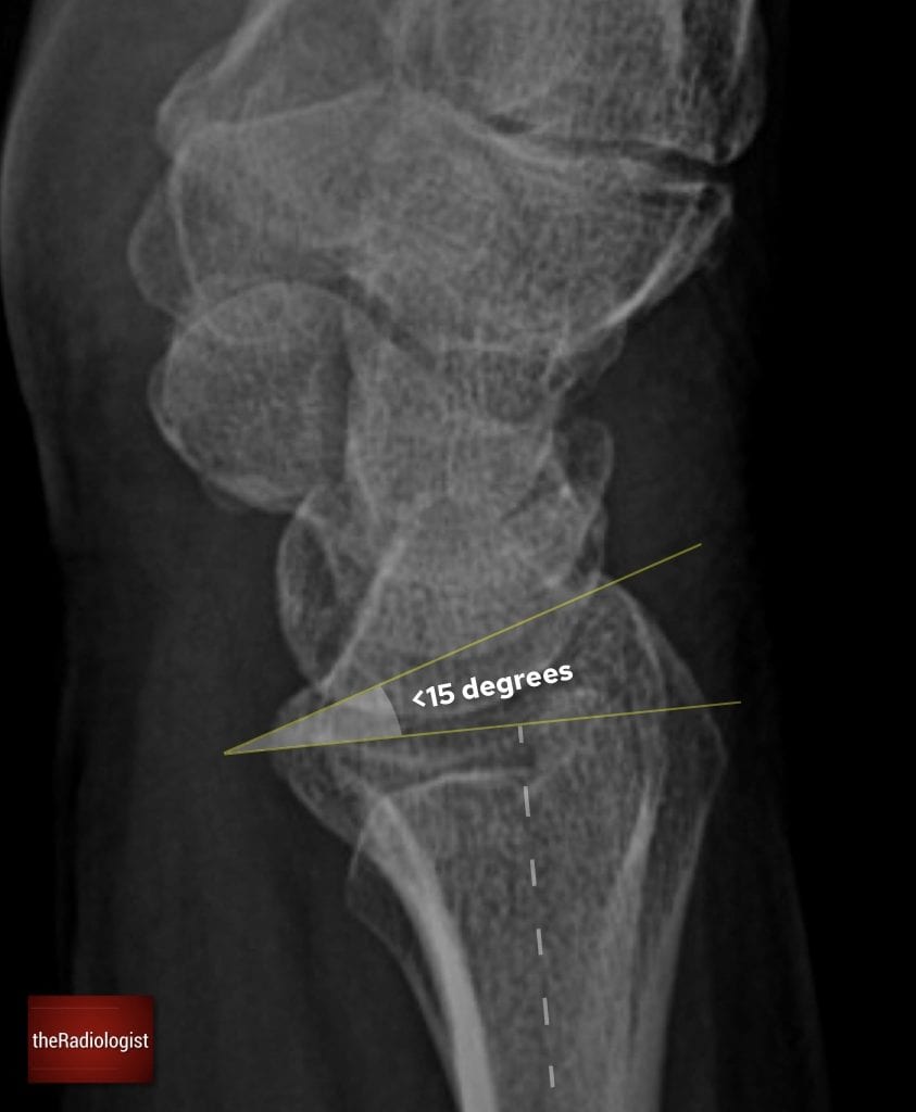 Hand and Wrist X-Ray Guide – the Radiologist