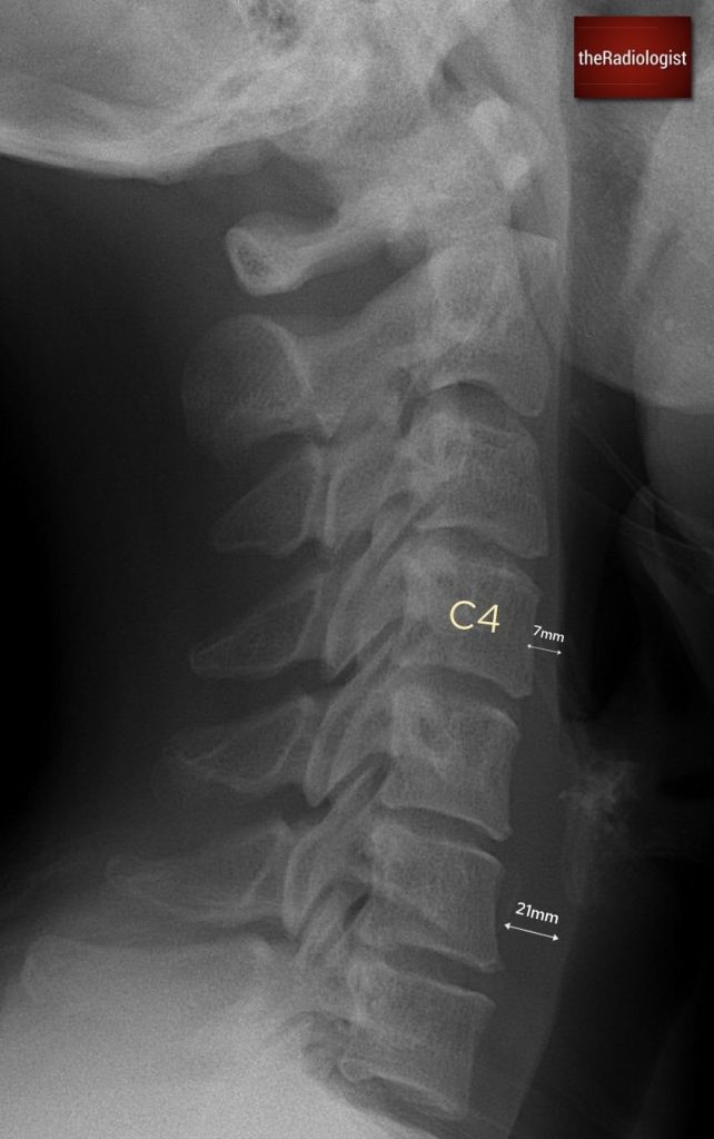 How to Read a Cervical Spine X-ray | Peg View & Alignment
