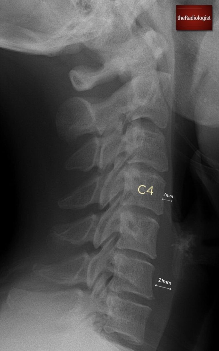 How to Read a Cervical Spine X-ray | Peg View & Alignment