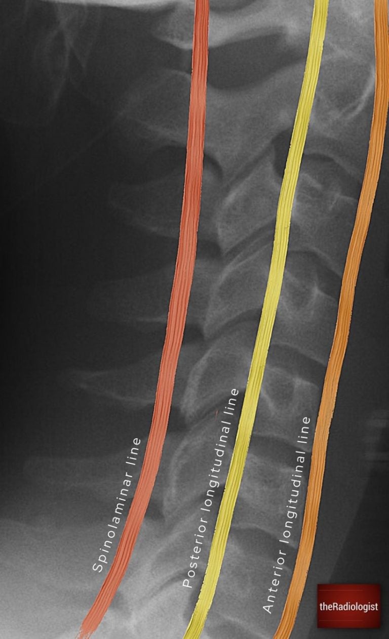 How to Read a Cervical Spine X-ray | Peg View & Alignment