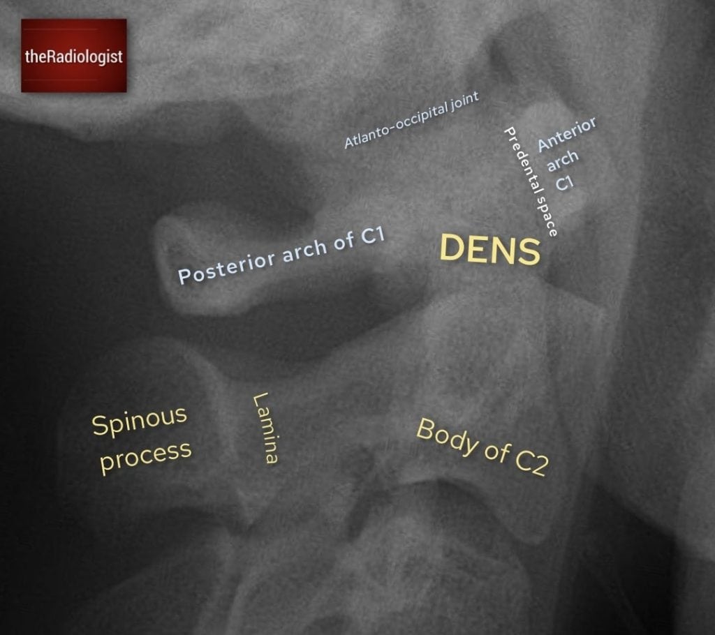 How to Read a Cervical Spine X-ray | Peg View & Alignment