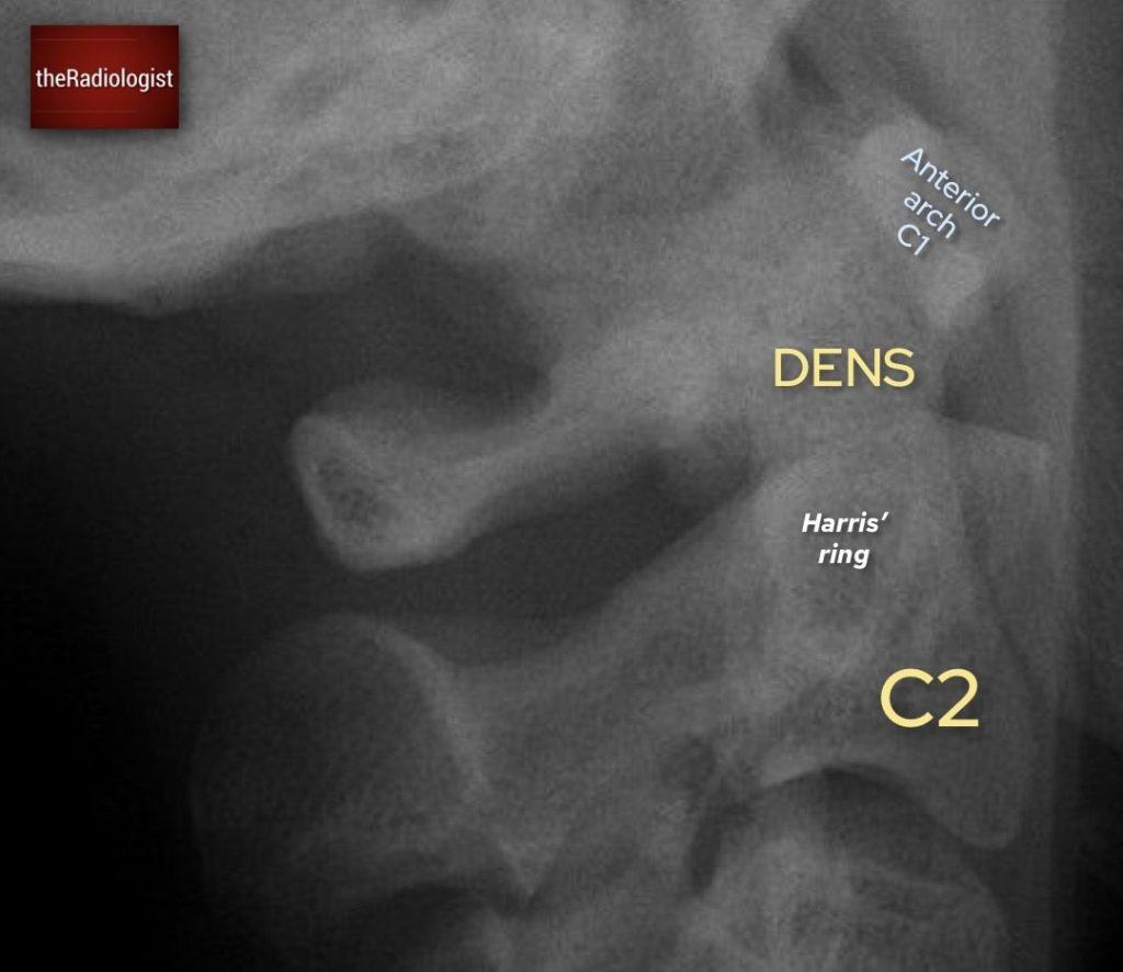 Cervical Spine X-Ray Essentials – the Radiologist