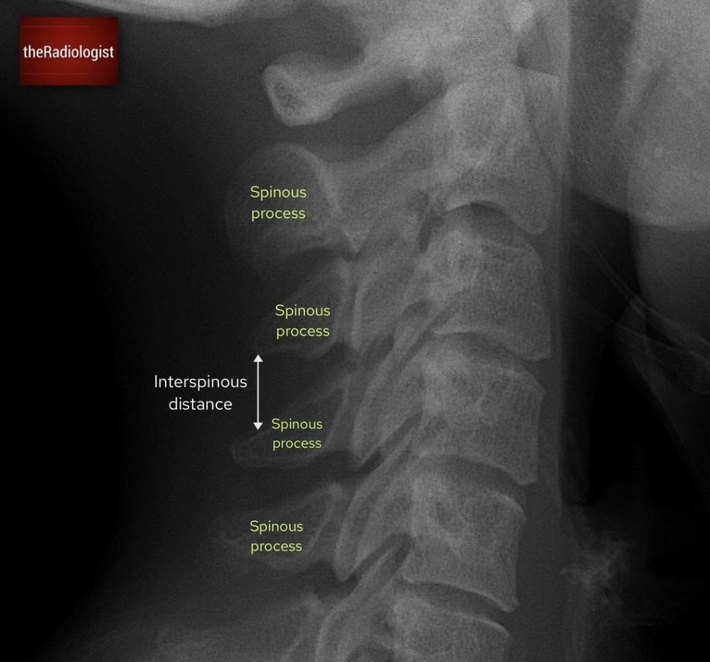 Cervical Spine X-Ray Essentials – the Radiologist
