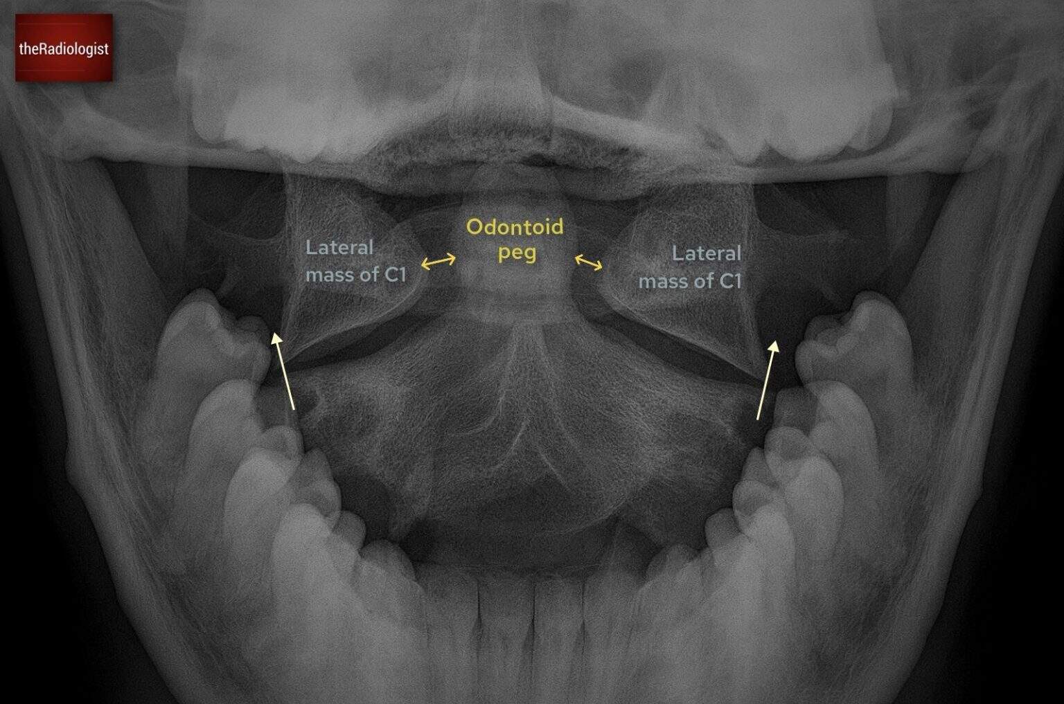 Cervical Spine X-Ray Essentials – the Radiologist