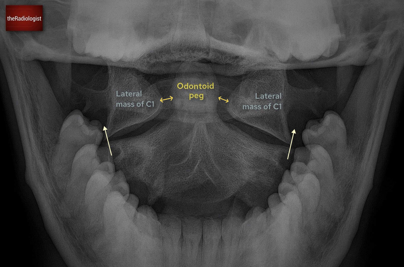 Cervical Spine X-Ray Essentials – the Radiologist
