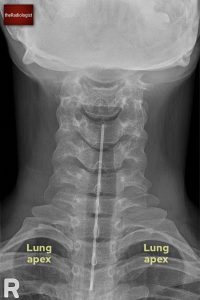 Cervical Spine X-Ray Essentials – the Radiologist