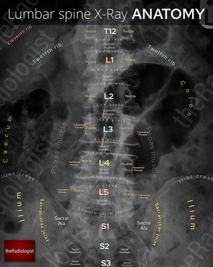 How to Read a Lumbar Spine X-Ray | AP and Lateral Guide