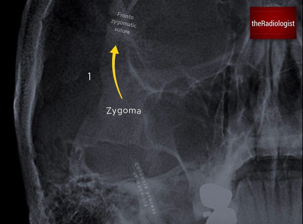 Facial bone X-Ray Guide – the Radiologist