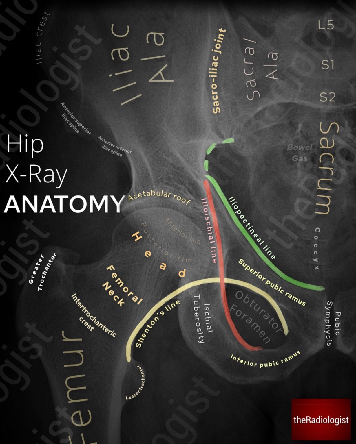 Pelvic X-Ray Guide – the Radiologist