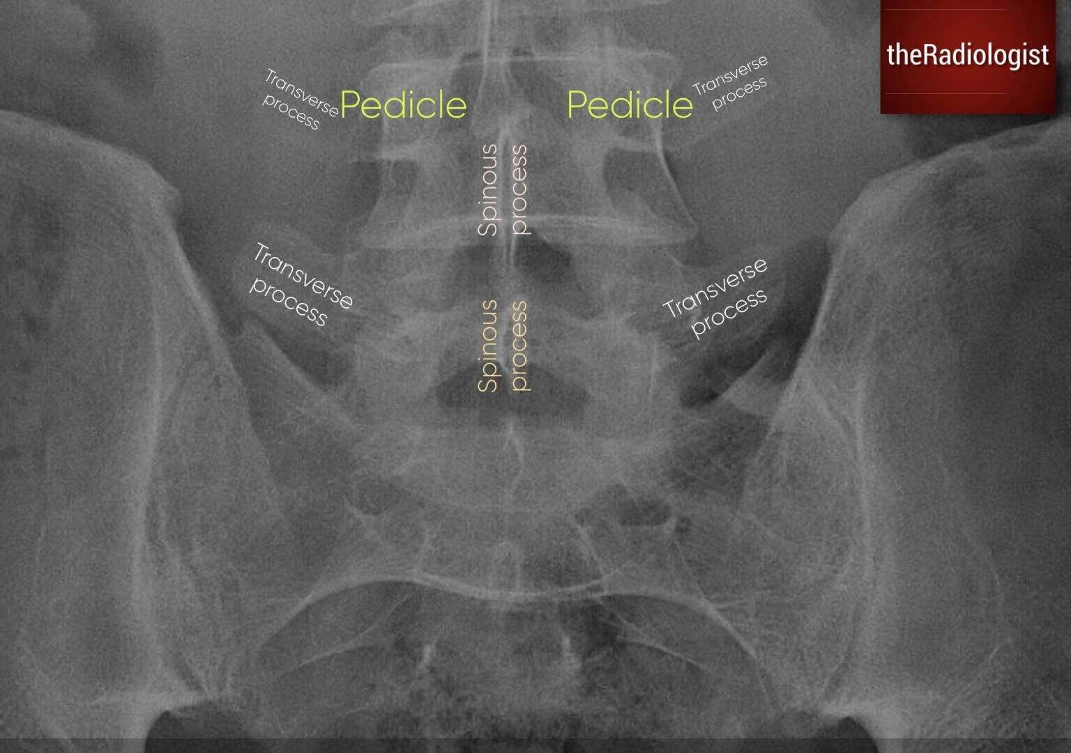 How to Read a Pelvis X-Ray | Anatomy and Trauma Guide