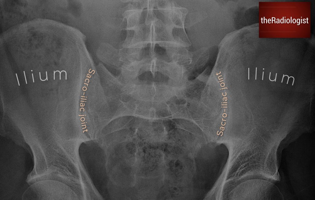Pelvic X-Ray Guide – the Radiologist