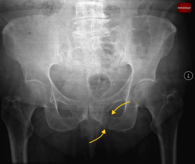 Pelvic X-Ray Guide – the Radiologist