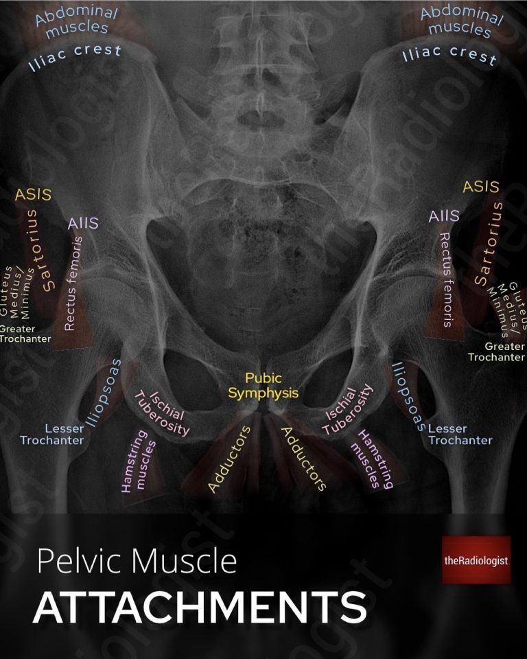Pelvic X-Ray Guide – the Radiologist