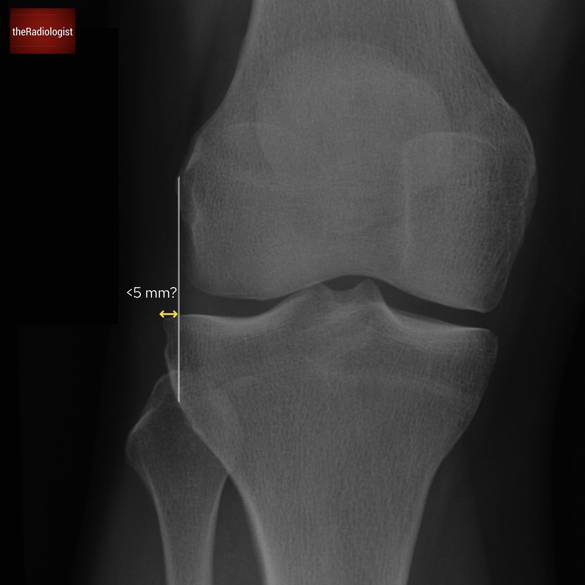 Knee X-Ray Guide – the Radiologist