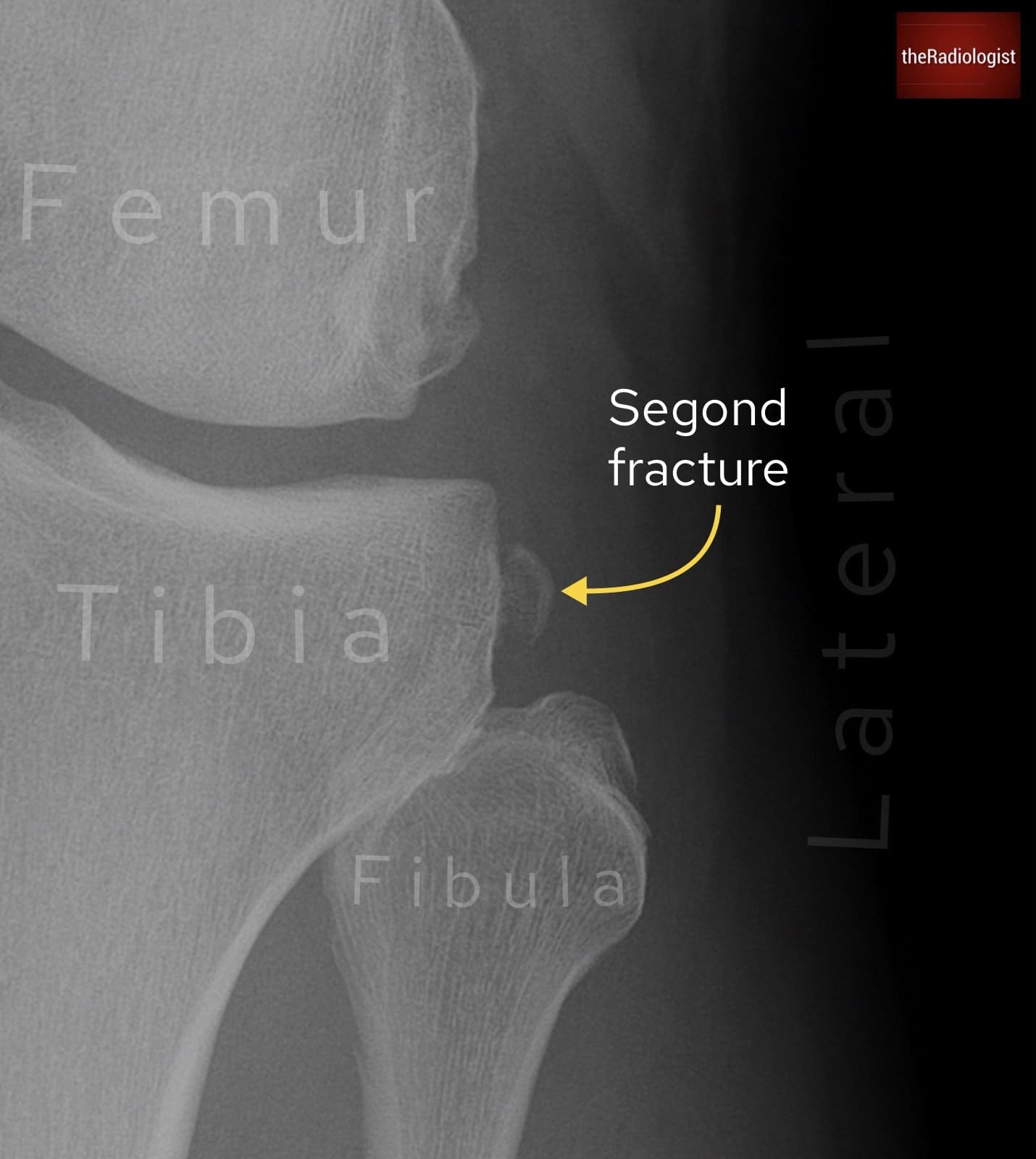 How to Read a Knee X-Ray | Anatomy and Alignment Guide