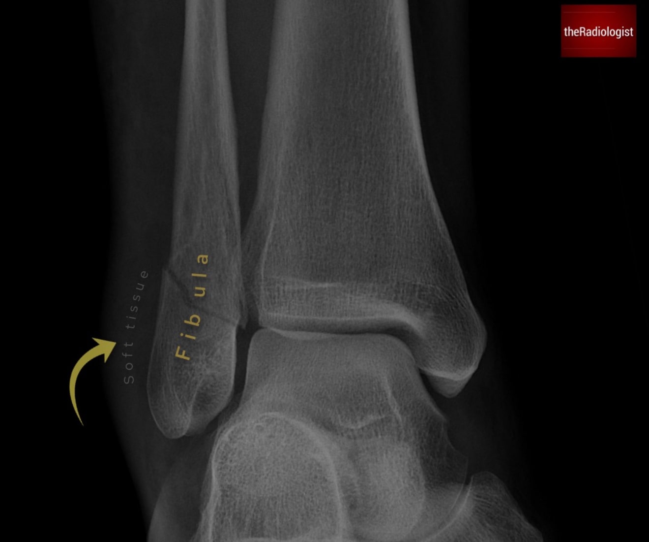 Foot and Ankle X-Ray Guide – the Radiologist