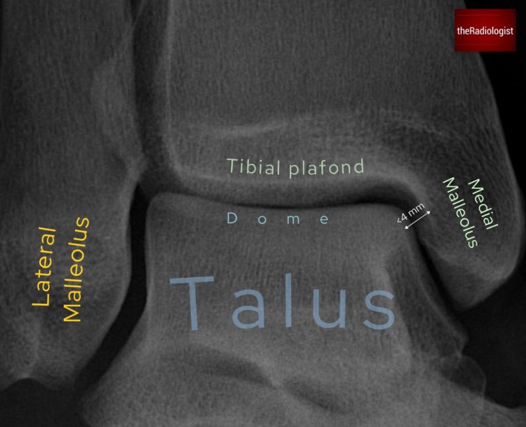 Foot and Ankle X-Ray Guide – the Radiologist