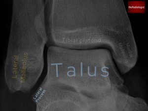Foot and Ankle X-Ray Guide – the Radiologist