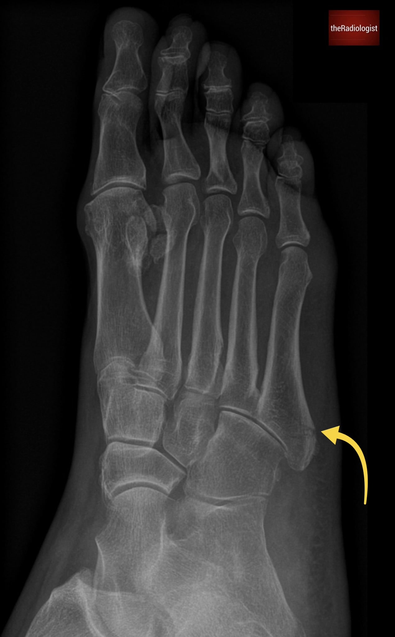 Foot and Ankle X-Ray Guide – the Radiologist