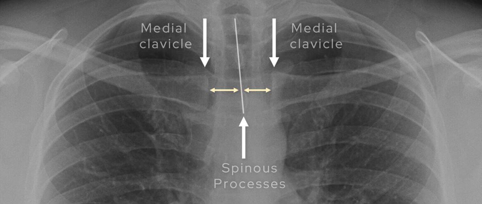 How to Read a Chest X-ray | CXR Interpretation Guide