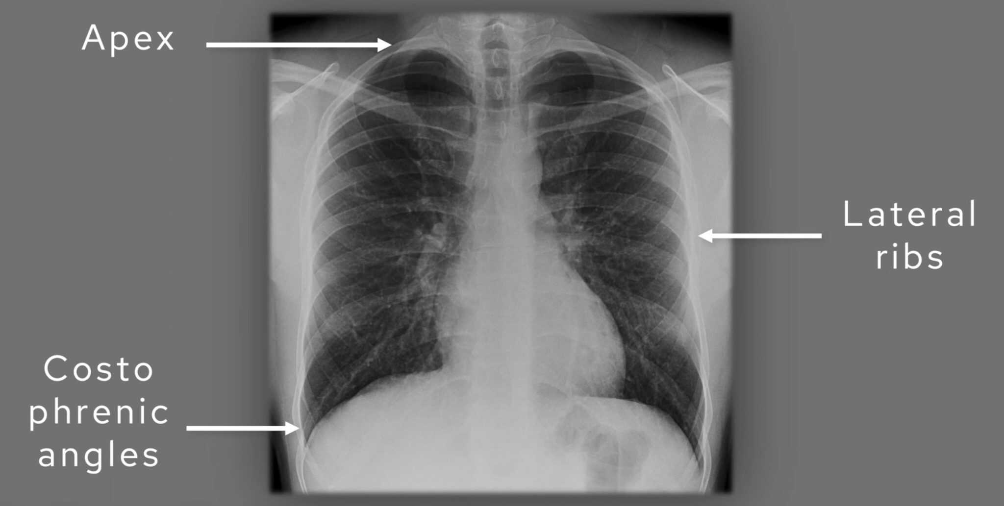 How to Read a Chest X-ray | CXR Interpretation Guide