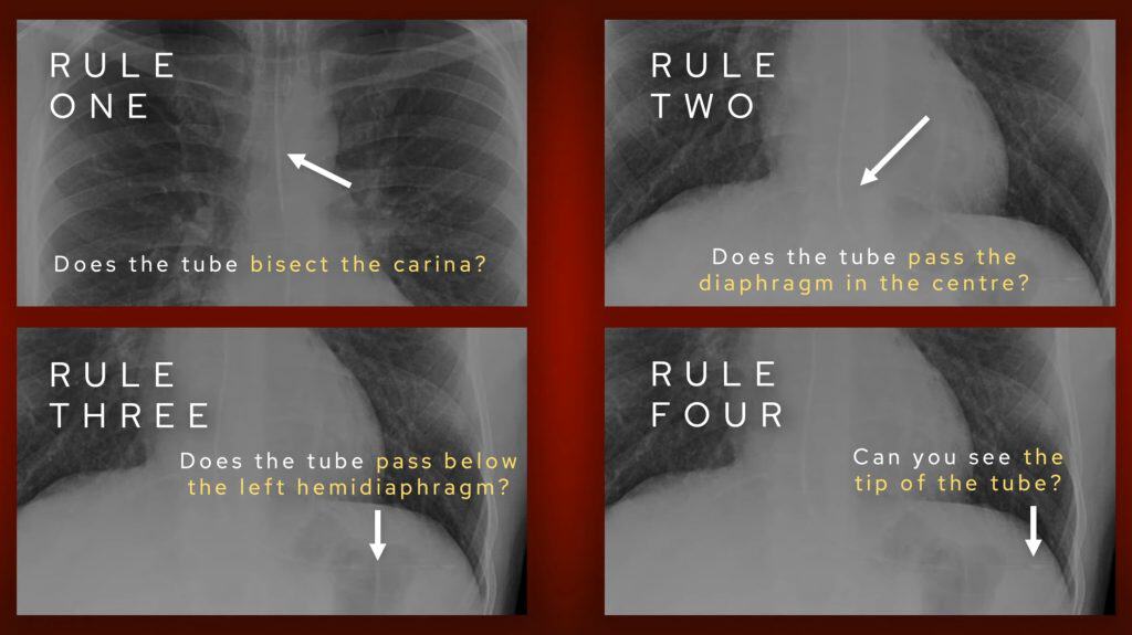 How to Read a Chest X-ray | CXR Interpretation Guide