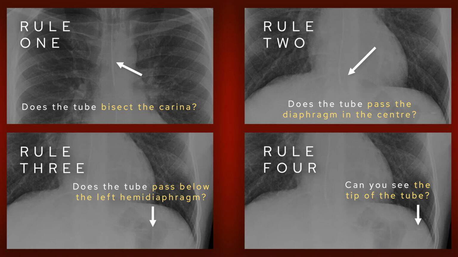 How to Read a Chest X-ray | CXR Interpretation Guide