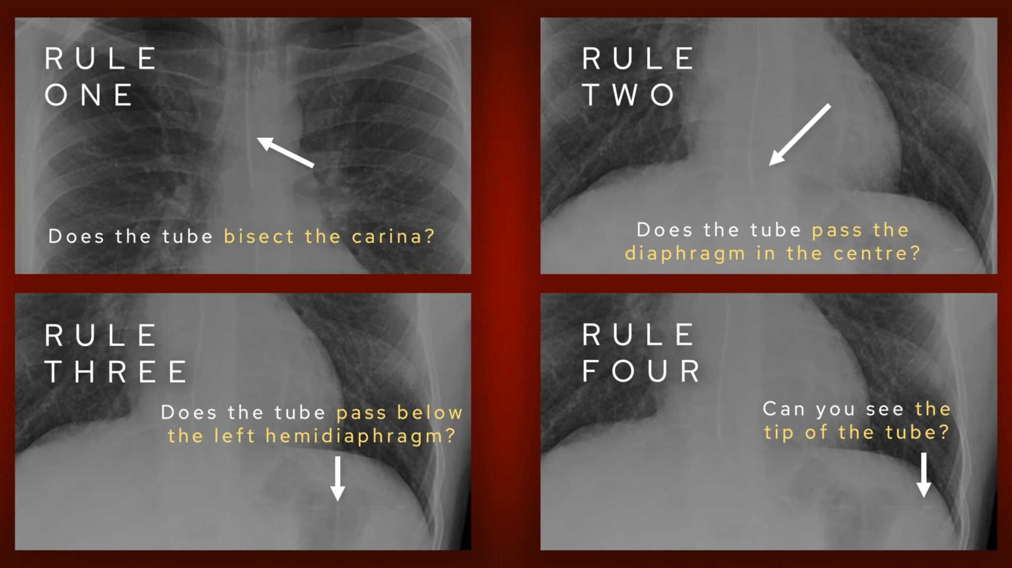How to Read a Chest X-ray | CXR Interpretation Guide