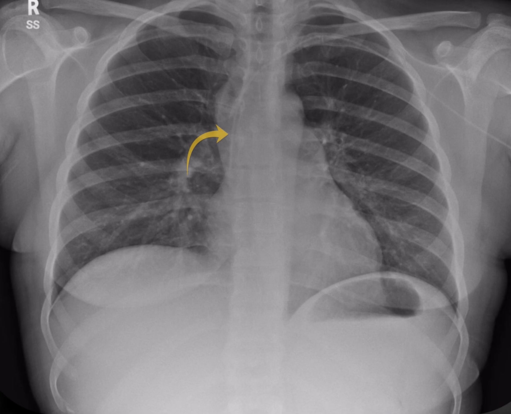 How to Read a Chest X-ray | CXR Interpretation Guide