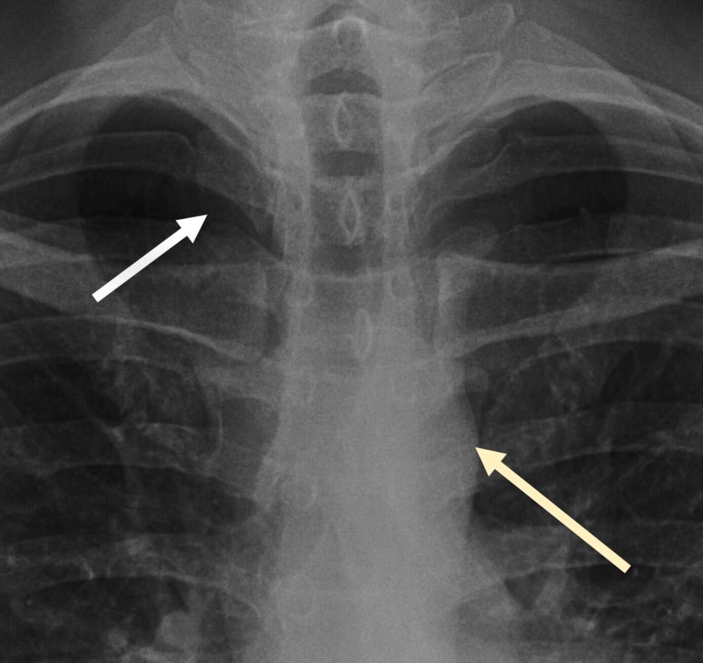 How to Read a Chest X-ray | CXR Interpretation Guide