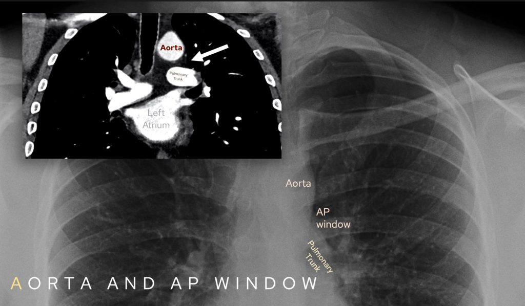 Chest X-Ray Review Areas – the Radiologist
