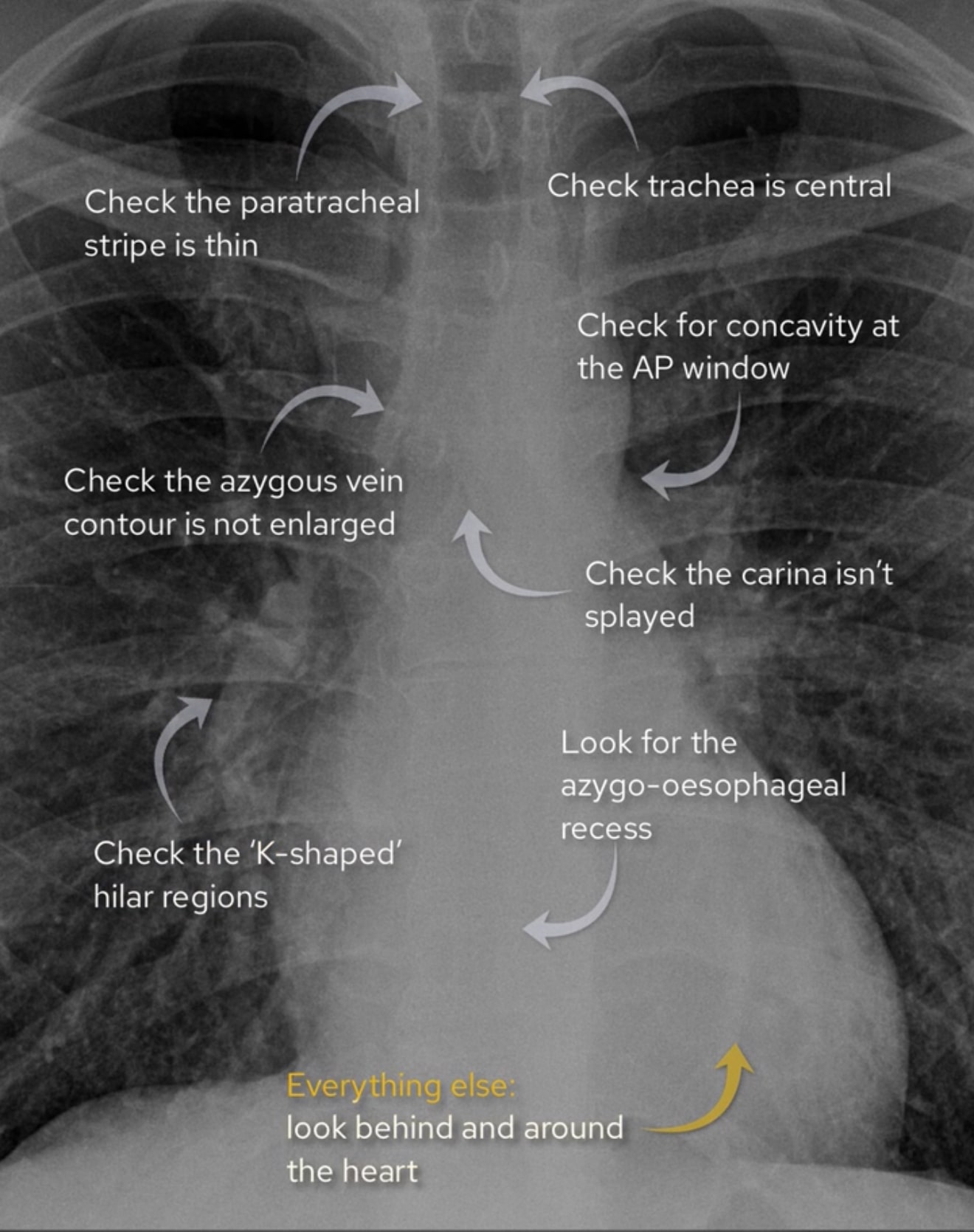 Chest X-Ray Review Areas – the Radiologist