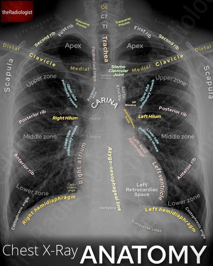 Chest X-Ray Review Areas – the Radiologist