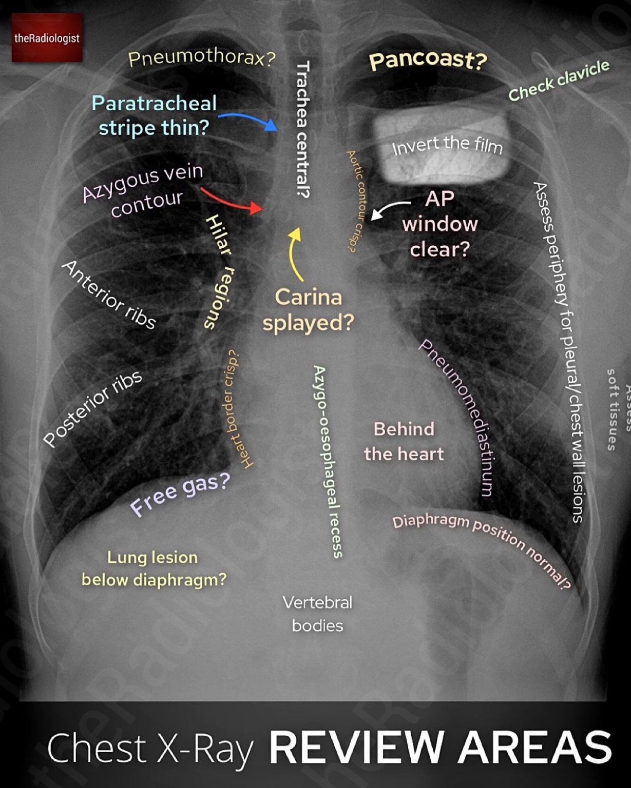 Chest X-Ray Review Areas – the Radiologist