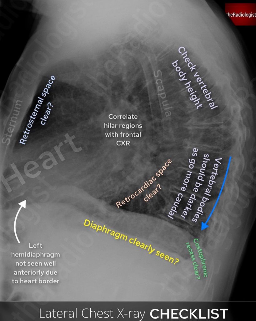 How to Read a Chest X-ray | CXR Interpretation Guide