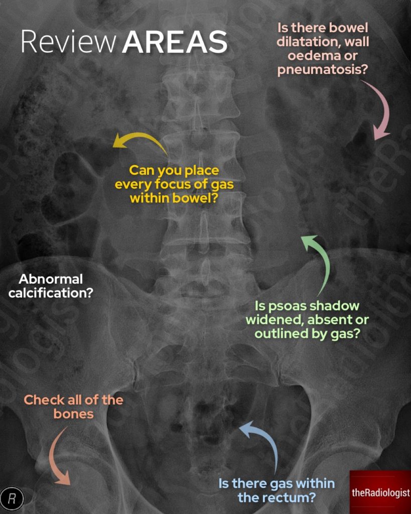 How to Read an Abdominal X-ray | AXR Interpretation Guide