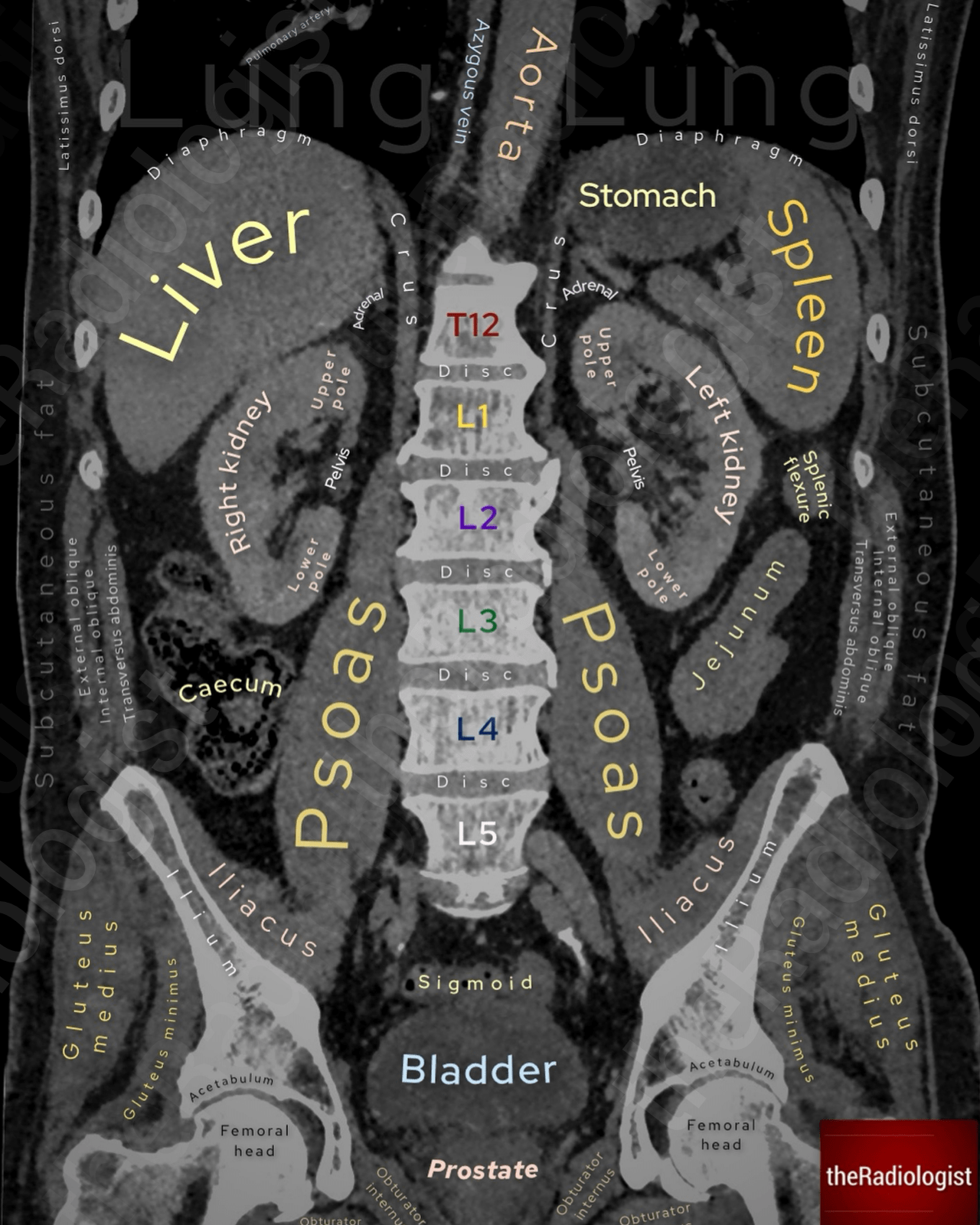 Psoas Abscess Radiology | CT and MRI Case